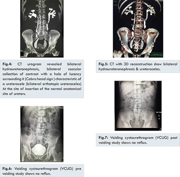Ureterocele Figure 3 From Prolapsing Ectopic Ureterocele Presenting As